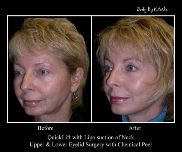 Face Lifts in Phoenix, AZ | Body By Kotoske | Phoenix Cosmetic Surgeon